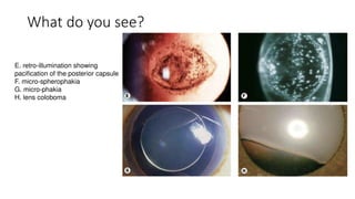 Spot Diagnosis - Look at the pictures-What do you See - Lens.pptx