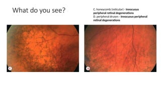 Spot Diagnosis - Look at the pictures-What do you See - Retinal ...
