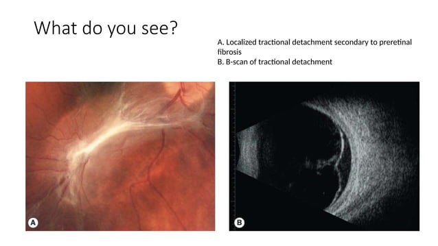 Spot Diagnosis - Look at the pictures-What do you See - Retinal Detachment.pptx