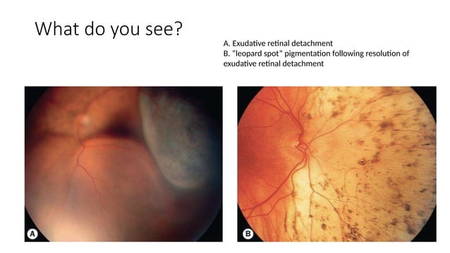 Spot Diagnosis - Look at the pictures-What do you See - Retinal Detachment.pptx