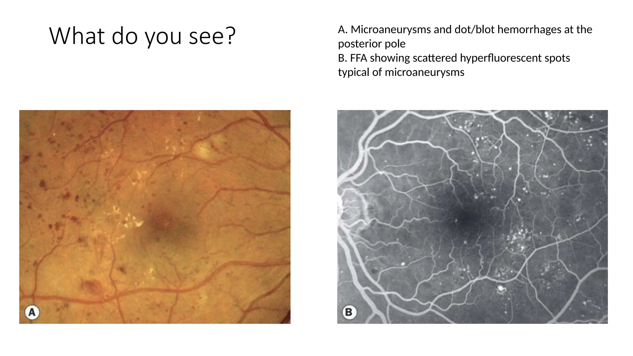Spot Diagnosis - Look at the pictures-What do you See - Retinal Vascula ...