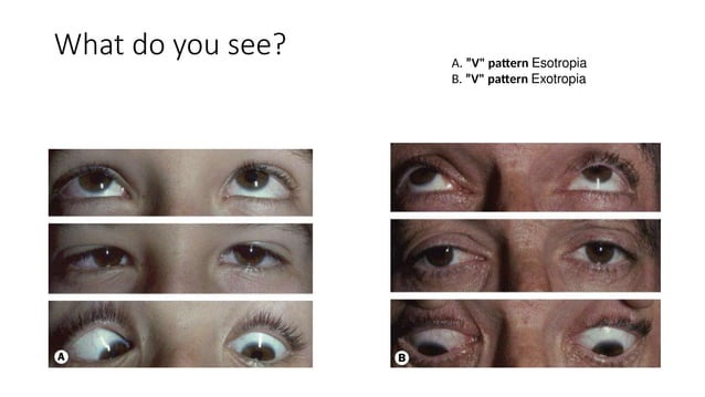 Spot Diagnosis - Look at the pictures-What do you See - Strabismus.pptx