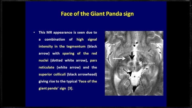 neuro radiology spotters | PPTX | Brain and Nervous System Disorders ...