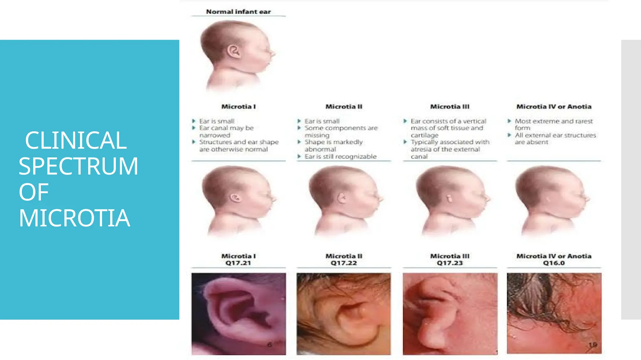 Plastic surgery spotter anotia types copy.pptx