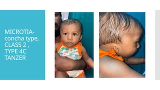 Plastic surgery spotter anotia types copy.pptx