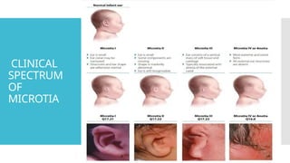 Plastic surgery spotter anotia types copy.pptx