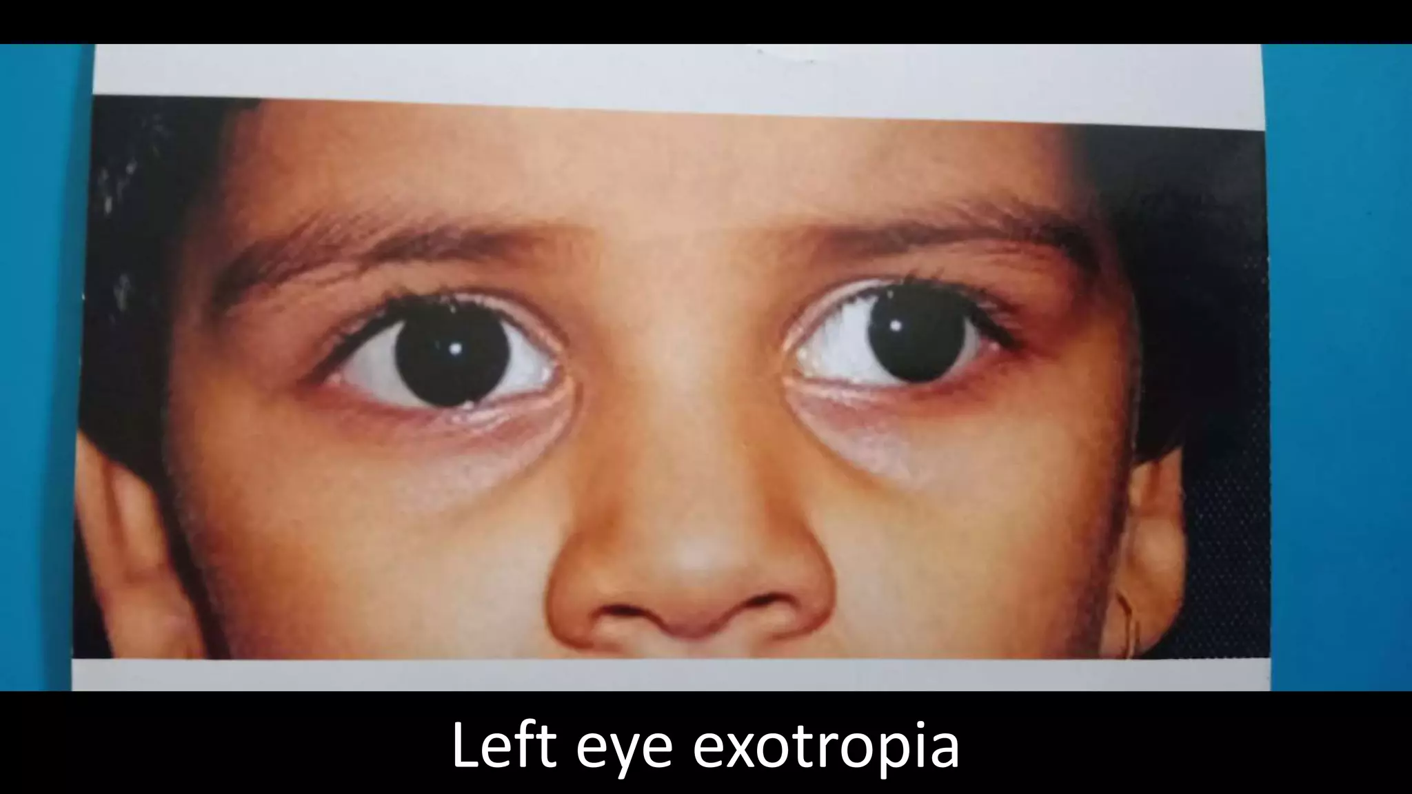 Ophthalmology OSCE | PPTX