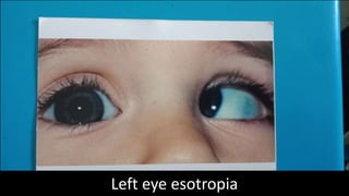 Ophthalmology OSCE | PPTX