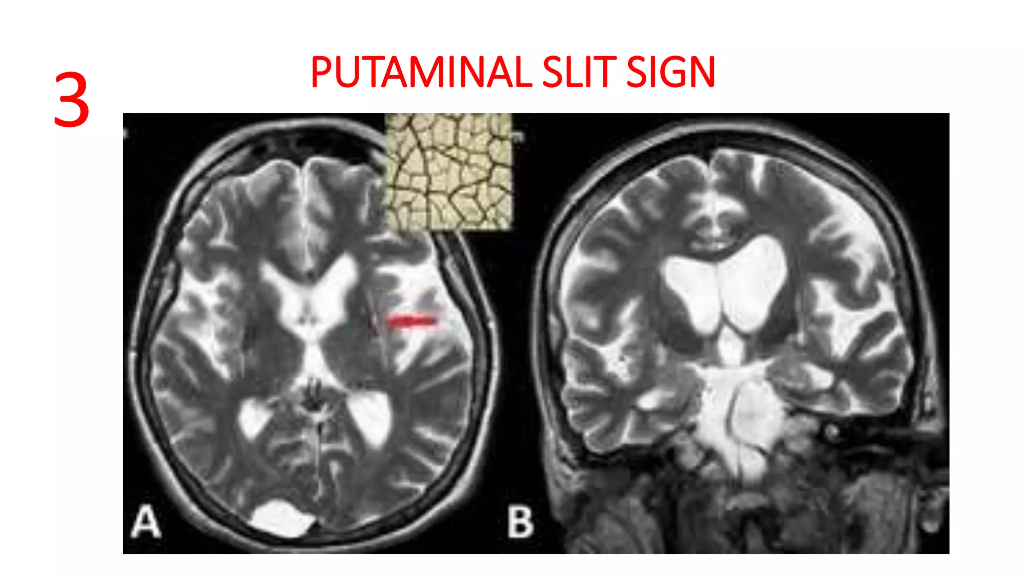 SPOTTERS IN NEUROLOGY | PPTX
