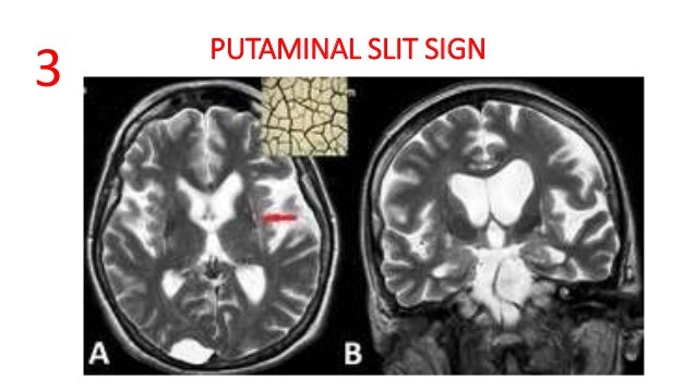 SPOTTERS IN NEUROLOGY