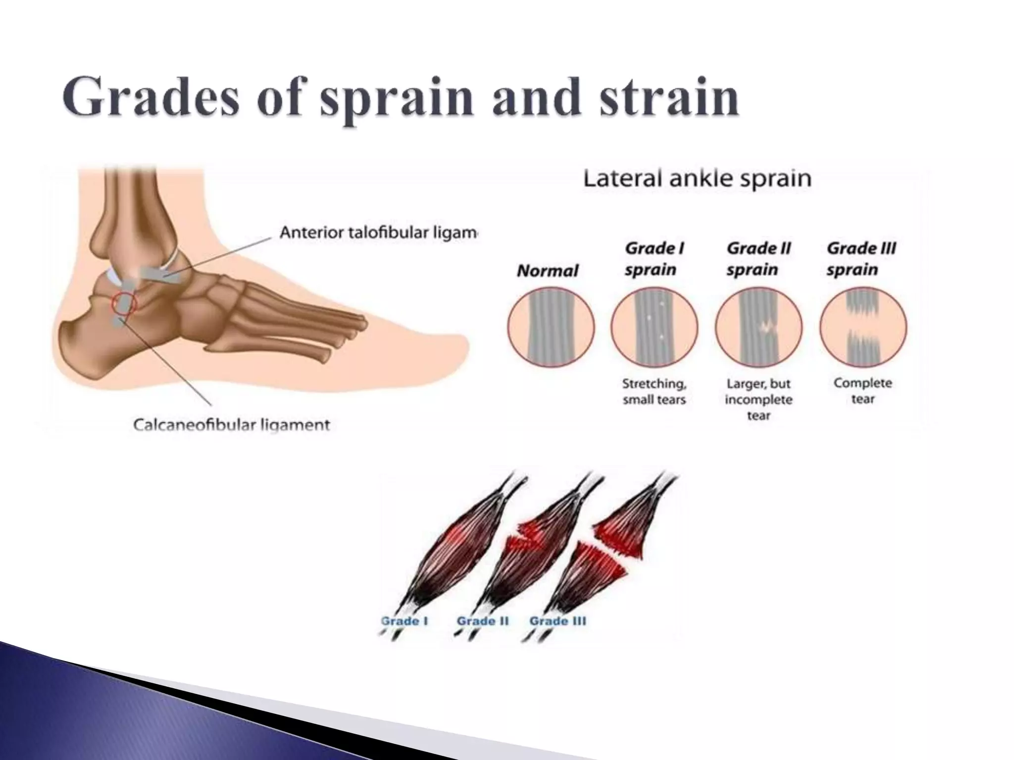 Sprain and Strain | PPTX