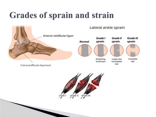 Emergency managemnts of strain and sprain.pptx | Death, Injury, or ...