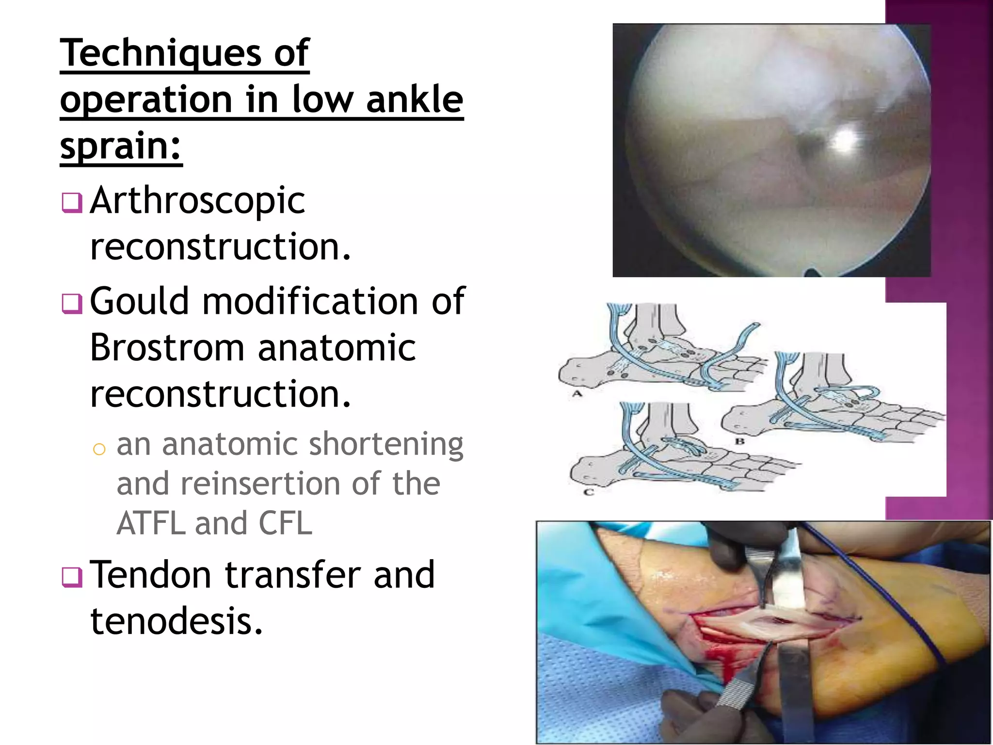 SPRAINED ANKLE | PPTX