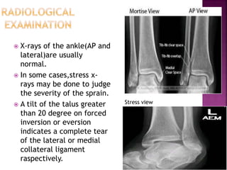 SPRAINED ANKLE | PPTX