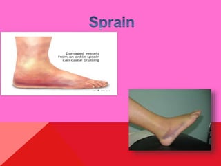 Sprains | PPT