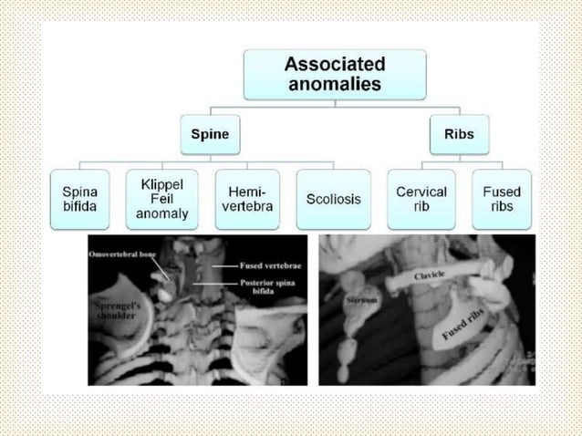 Sprengle shoulder (congenital elevation of scapula) | PPTX