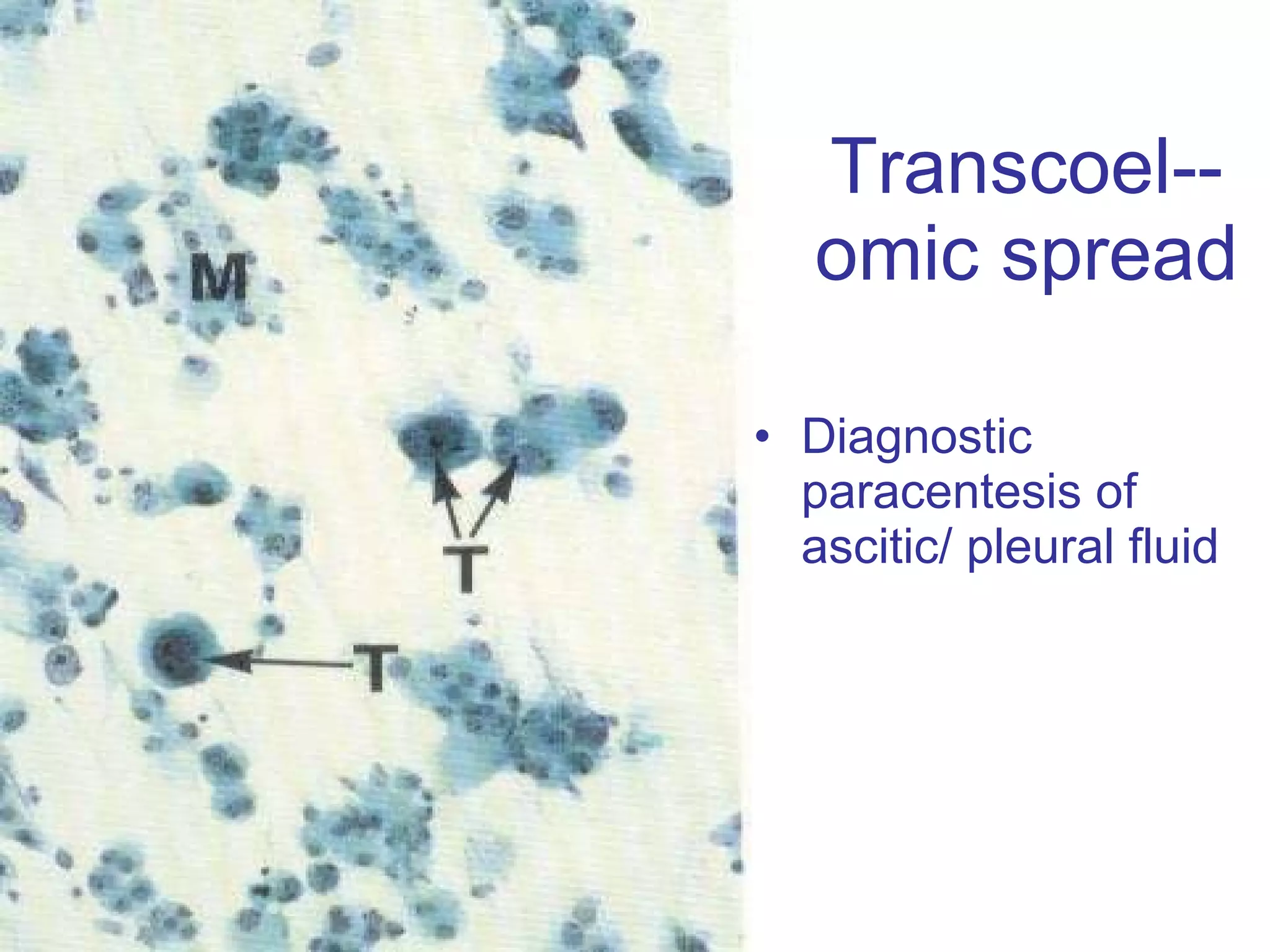 Spread of tumours | PPT