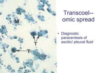Spread of tumours | PPT