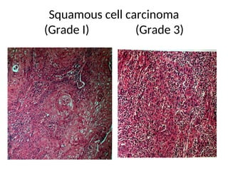 presentation,Spread of tx, grading and staging.ppt | Cancer | Diseases ...
