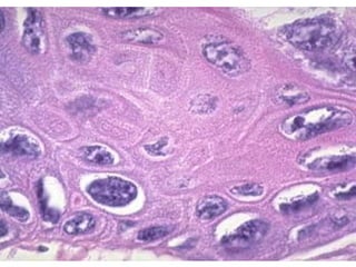 presentation,Spread of tx, grading and staging.ppt | Cancer | Diseases ...