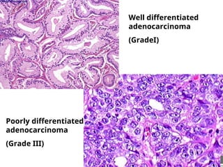 presentation,Spread of tx, grading and staging.ppt | Cancer | Diseases ...