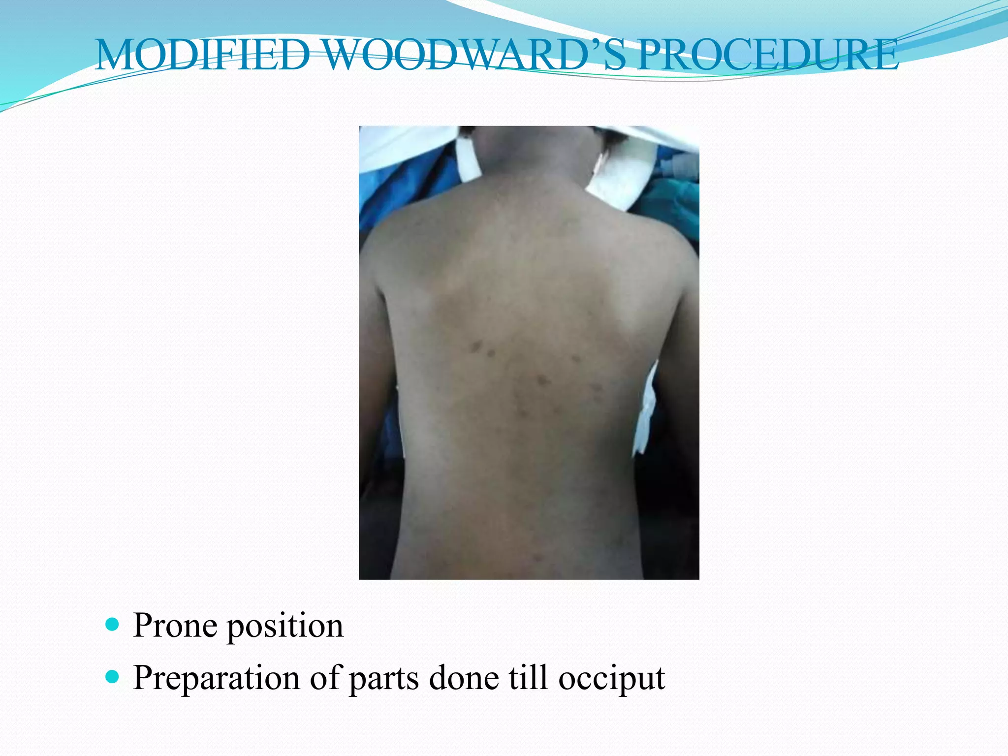 Sprengel deformity | PPTX