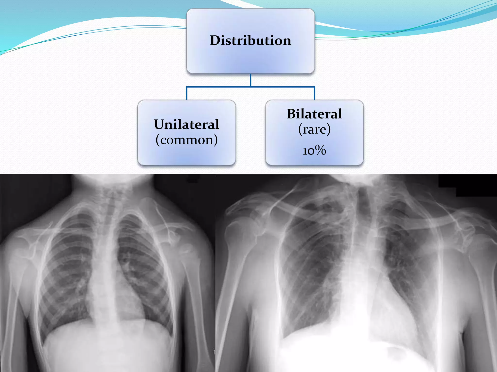Sprengel deformity | PPTX