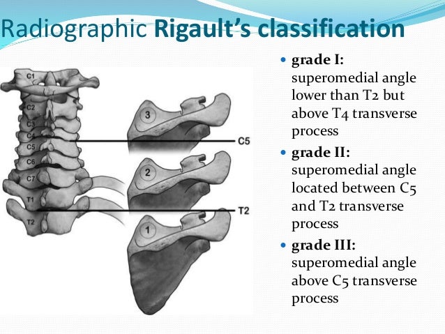 Sprengel deformity