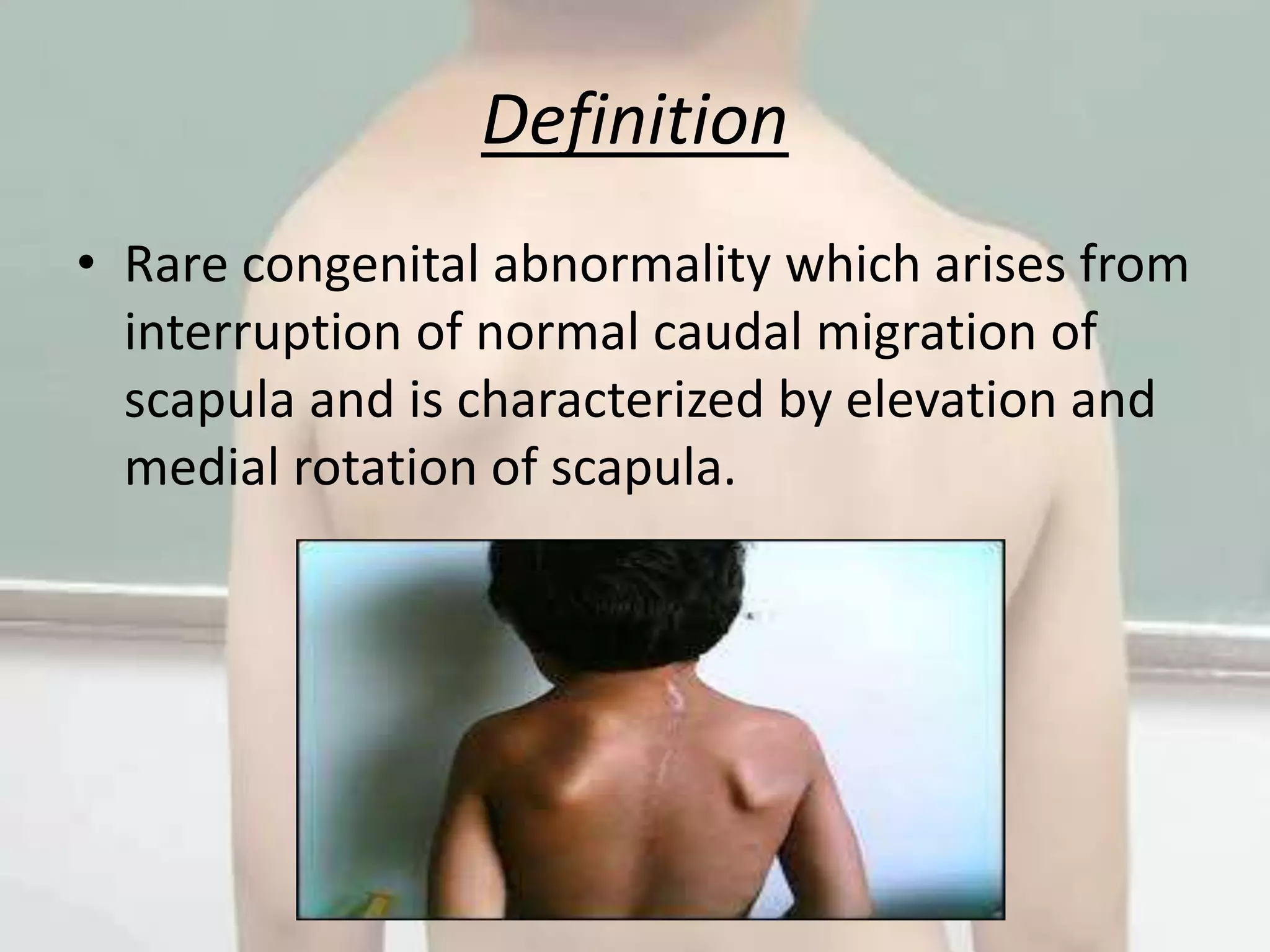 Sprengel’s shoulder | PPTX