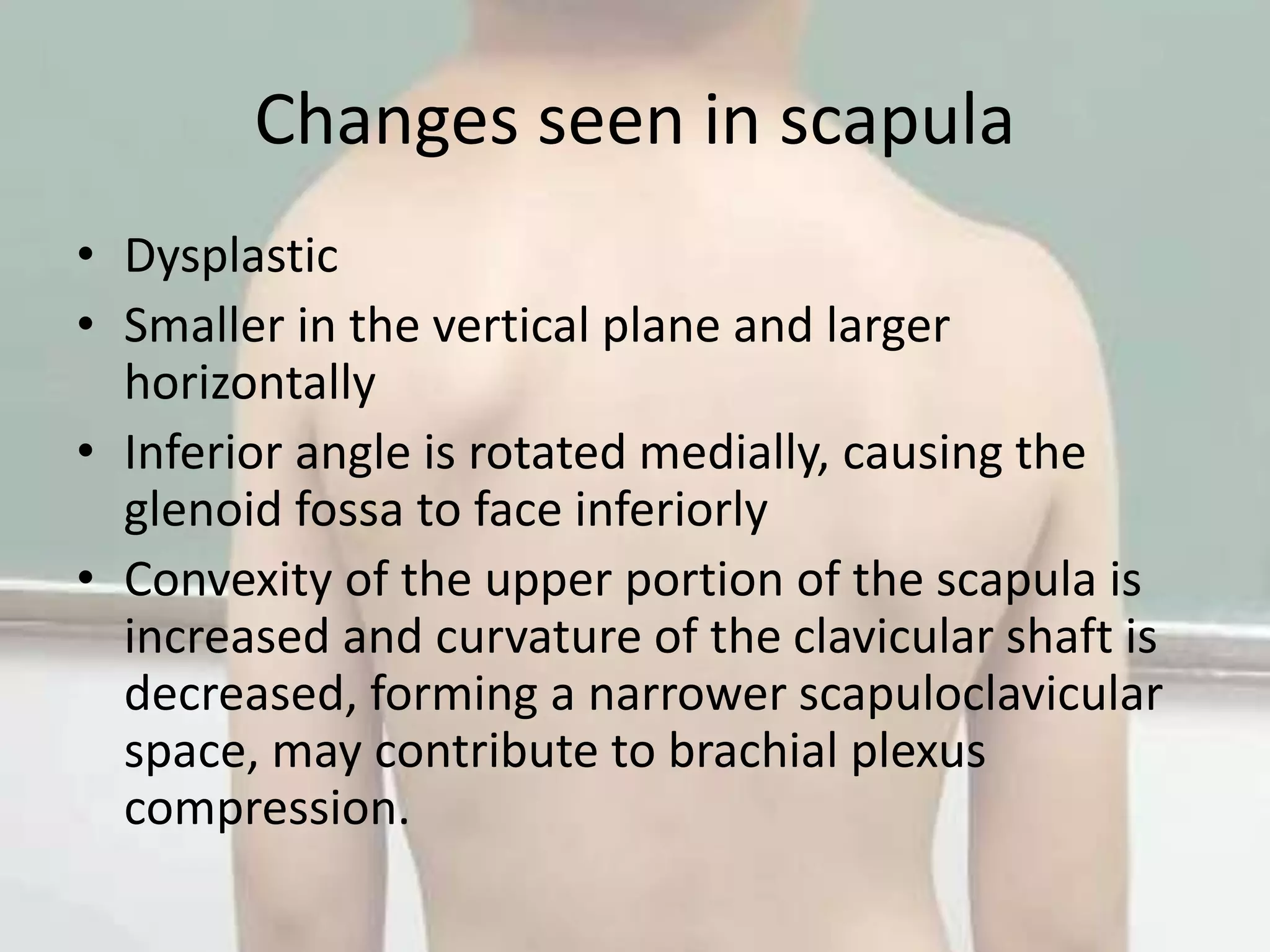 Sprengel’s shoulder | PPTX