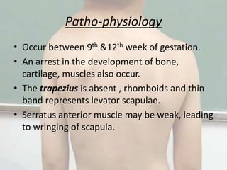 Sprengel’s shoulder | PPTX