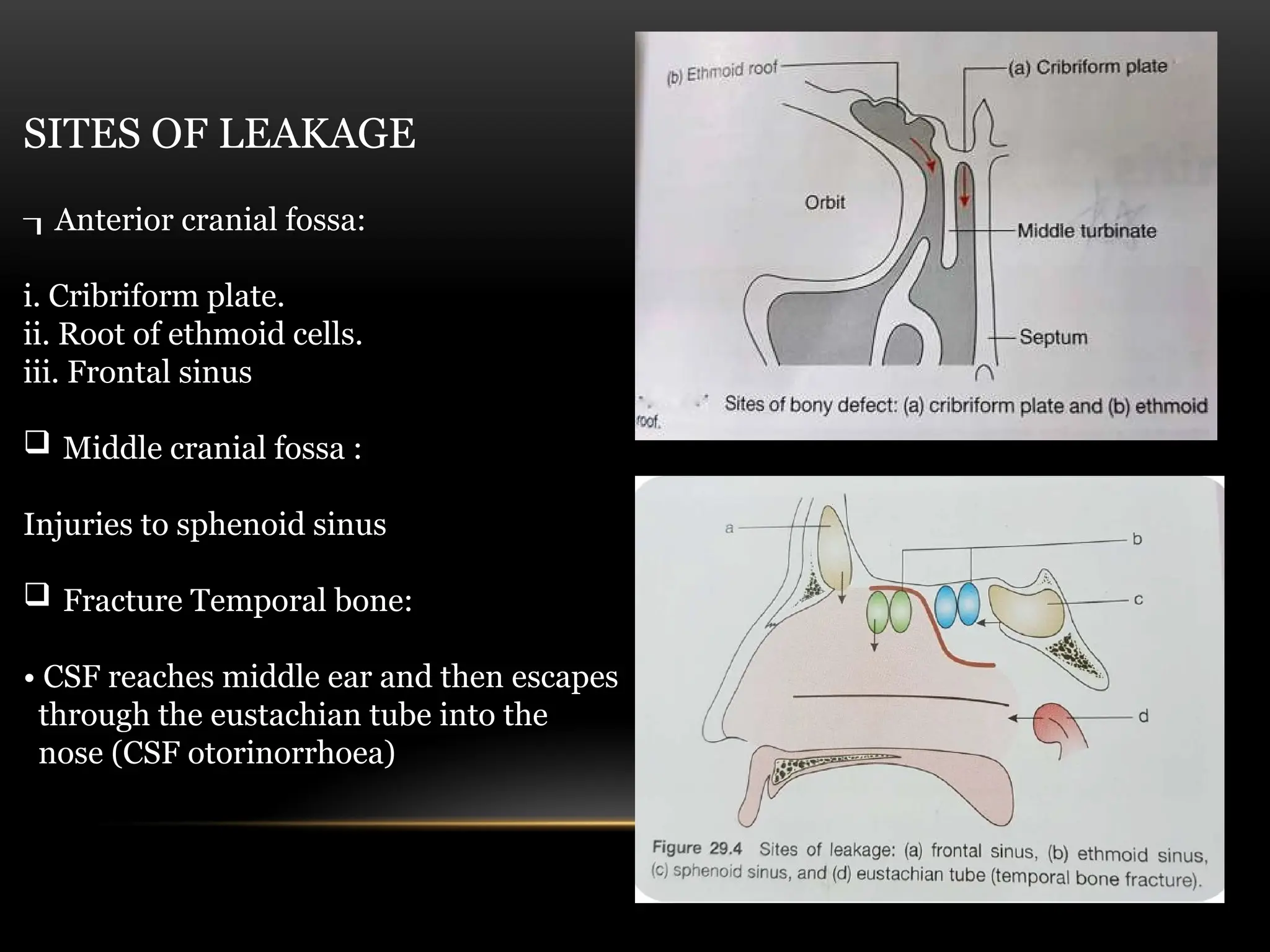 S Pritam NASO-ORBITO-ETHMOID COMPLEX FRACTURES.pptx