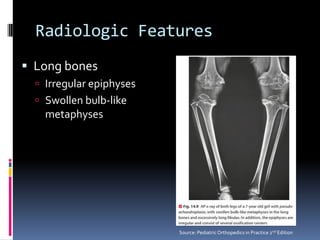 Pseudoachondroplasia | PDF