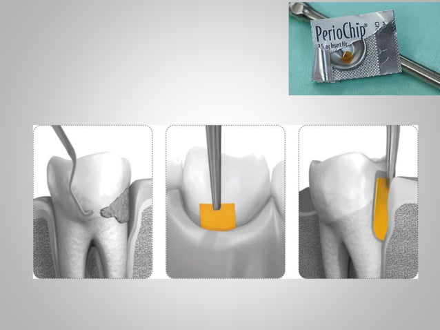 Supportive Periodontal Therapy | PPTX