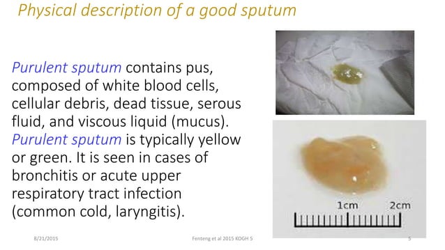 Sputum Examination and Analysis | PPTX | Lung and Respiratory Health ...
