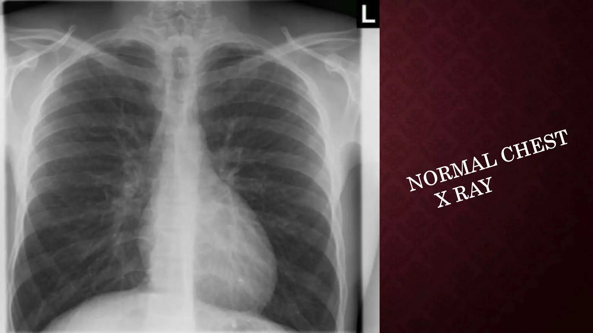 Sputum, chest x rays & spirometry | PPTX