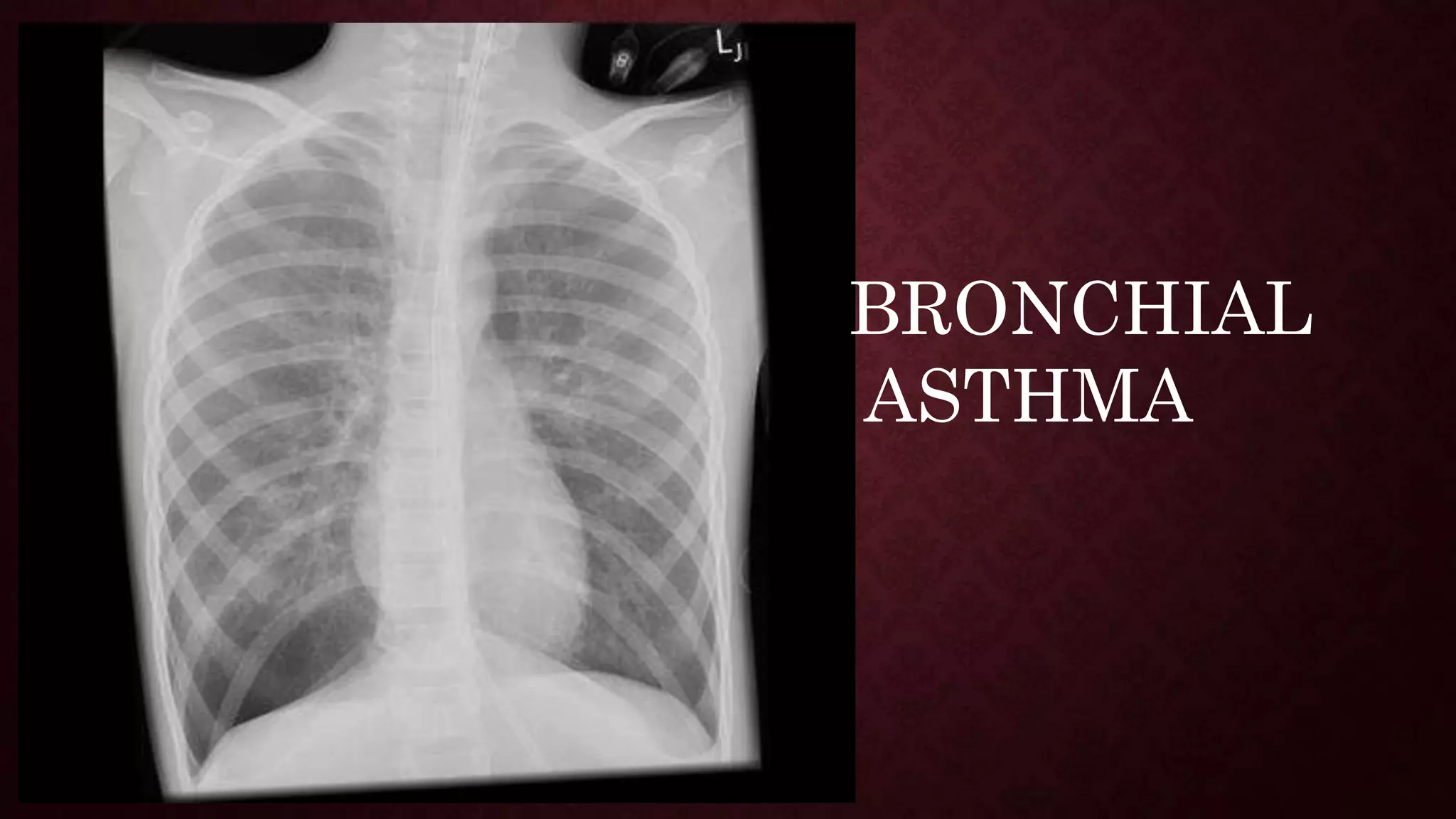 Sputum, chest x rays & spirometry | PPTX