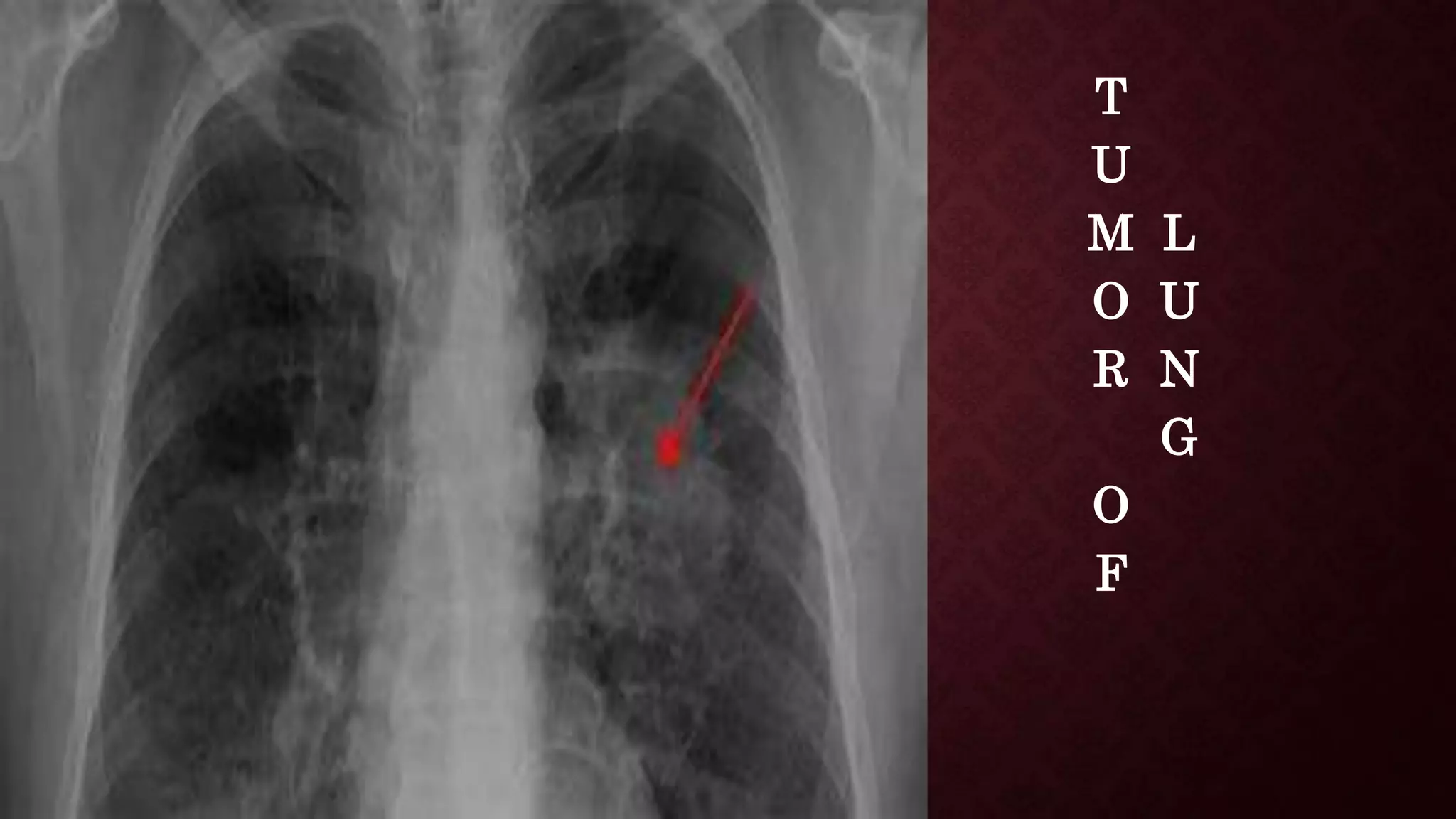 Sputum, chest x rays & spirometry | PPTX