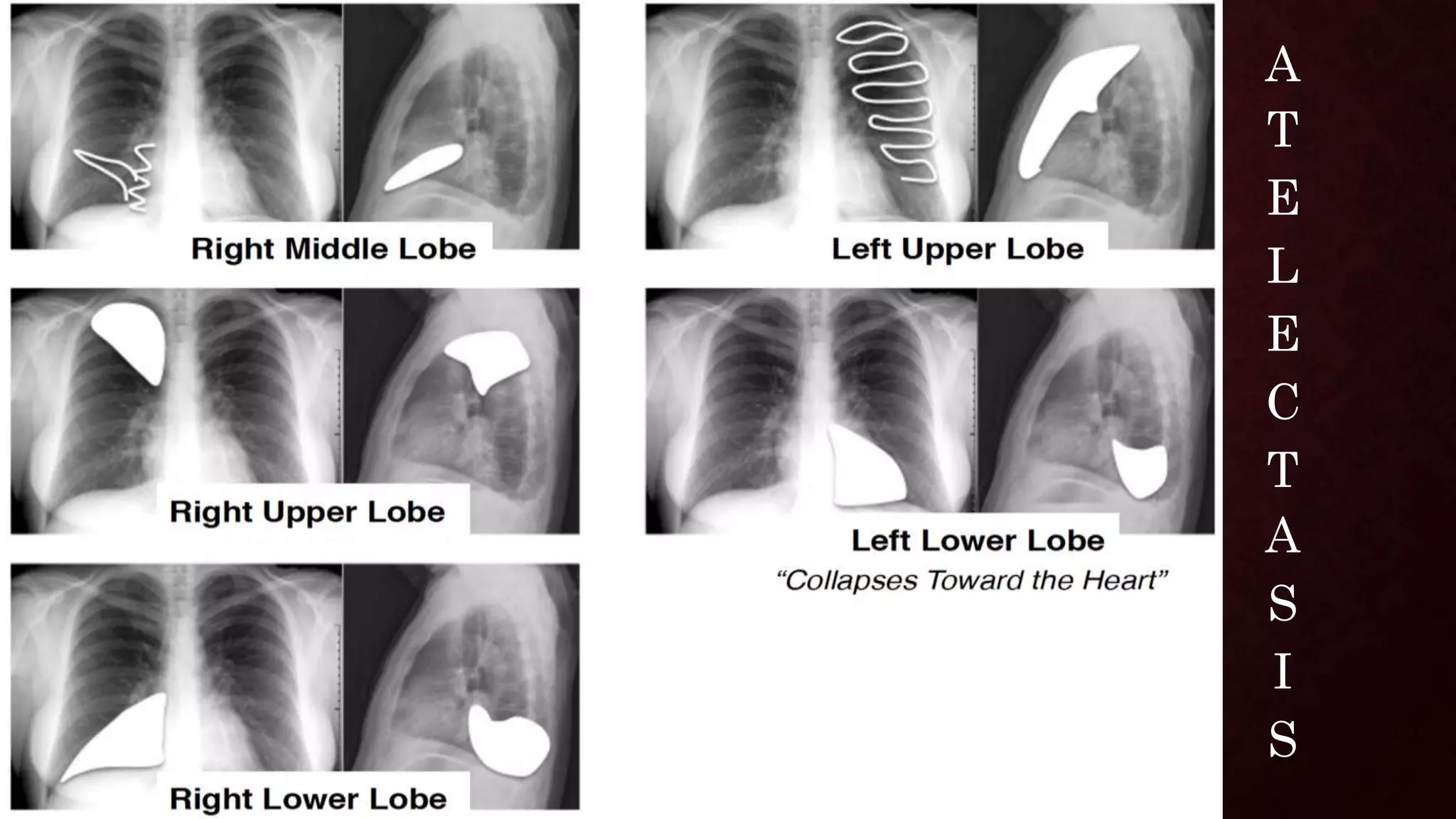 Sputum, chest x rays & spirometry | PPTX