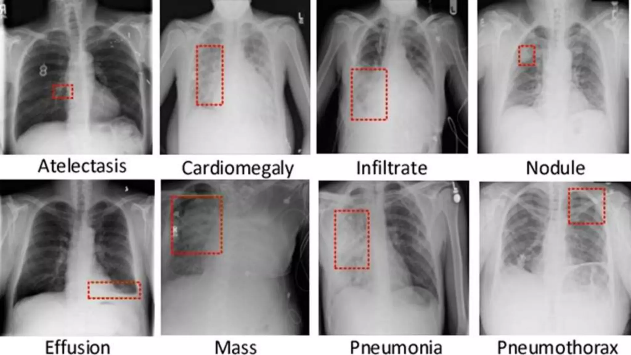 Sputum, chest x rays & spirometry | PPTX | Lung and Respiratory Health | Diseases and Conditions