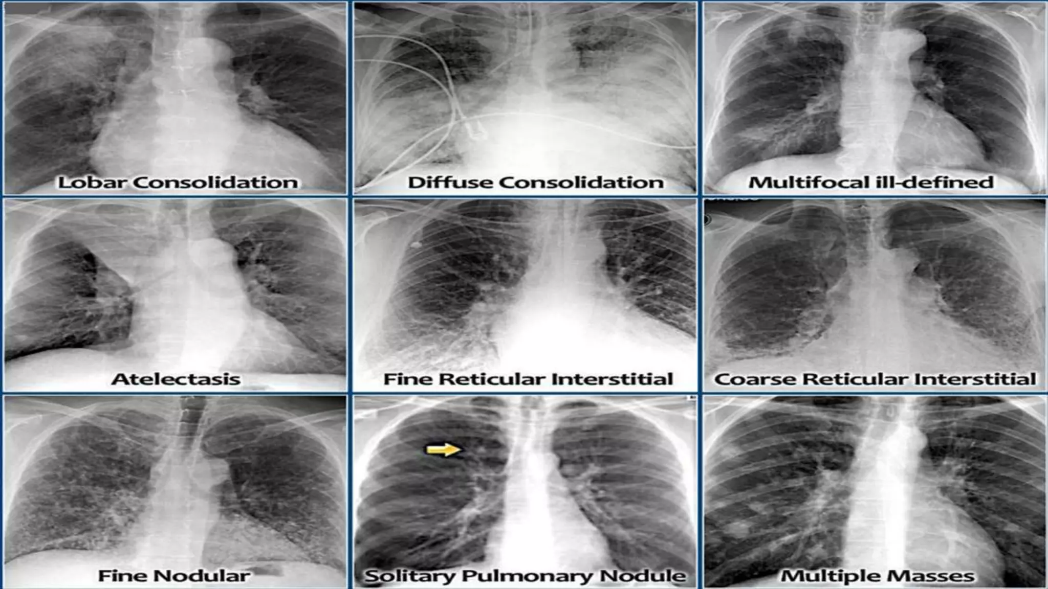 Sputum, chest x rays & spirometry | PPTX