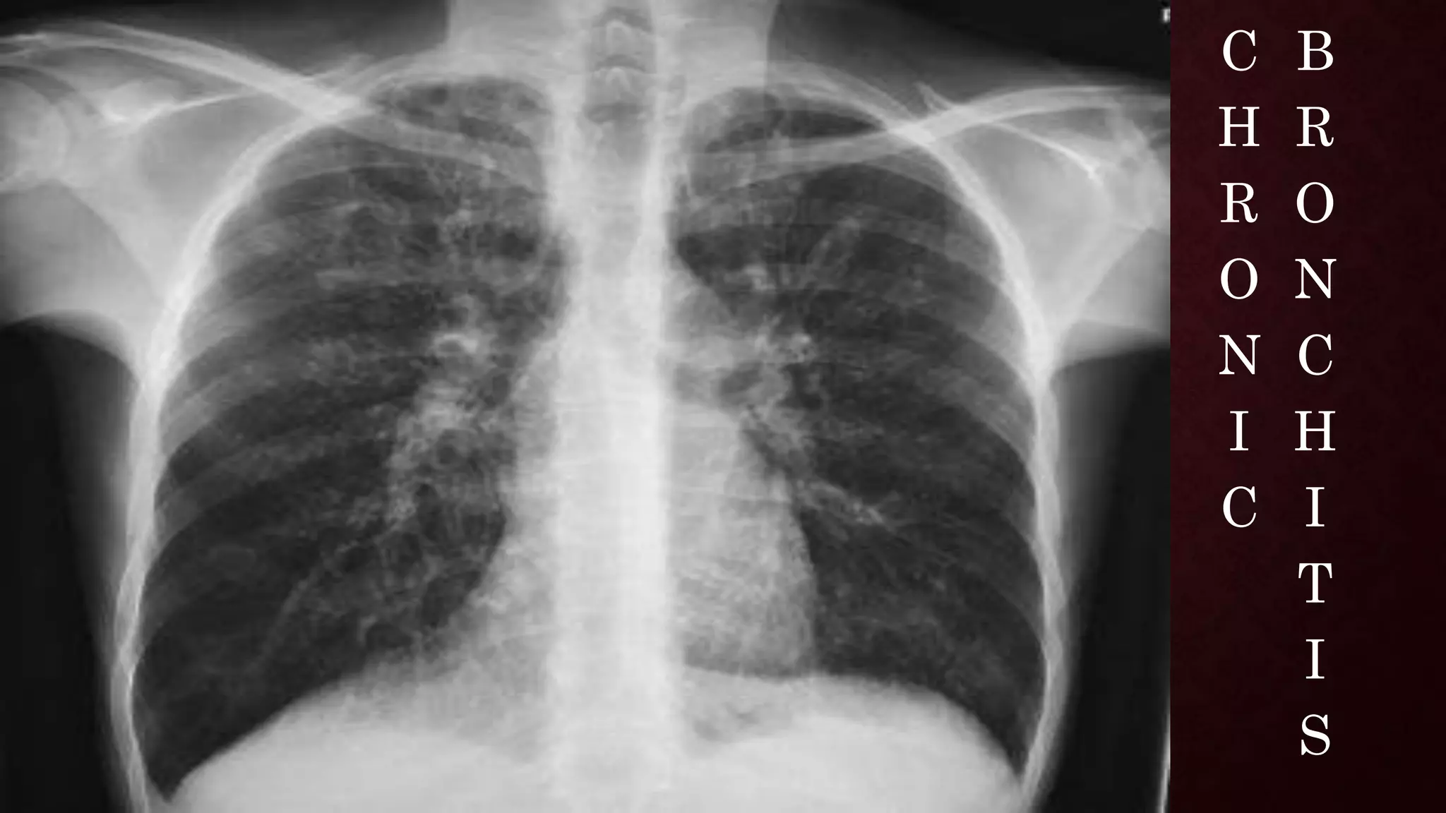 Sputum, chest x rays & spirometry | PPTX
