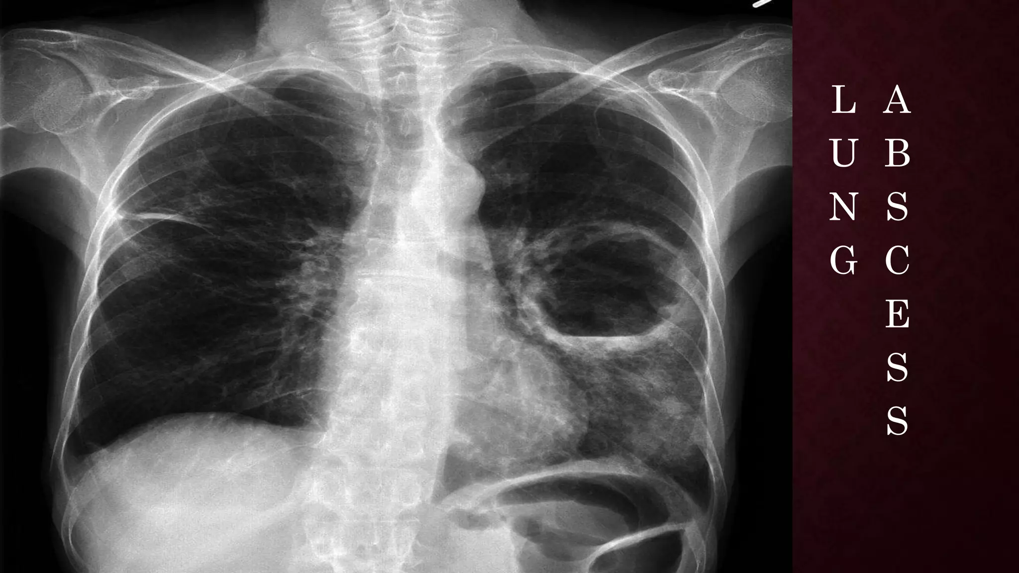 Sputum, chest x rays & spirometry | PPTX