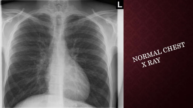 Sputum, chest x rays & spirometry | PPTX | Lung and Respiratory Health ...