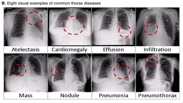 Sputum, chest x rays & spirometry | PPTX | Lung and Respiratory Health ...