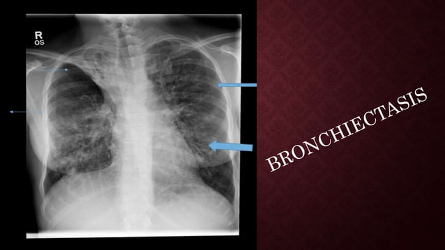 Sputum, chest x rays & spirometry | PPTX | Lung and Respiratory Health ...
