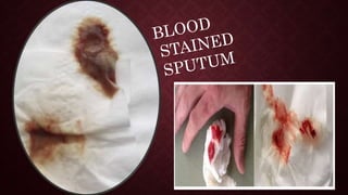 Sputum, chest x rays & spirometry | PPTX