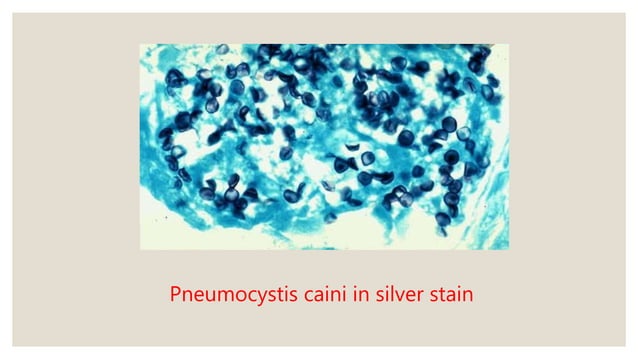 Sputum examination cytology and microscopy | PPTX