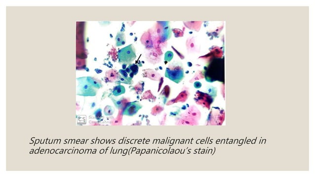 Sputum examination cytology and microscopy