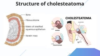 "Chronic Otitis Media: Understanding Squamousal Type CSOM and Its ...